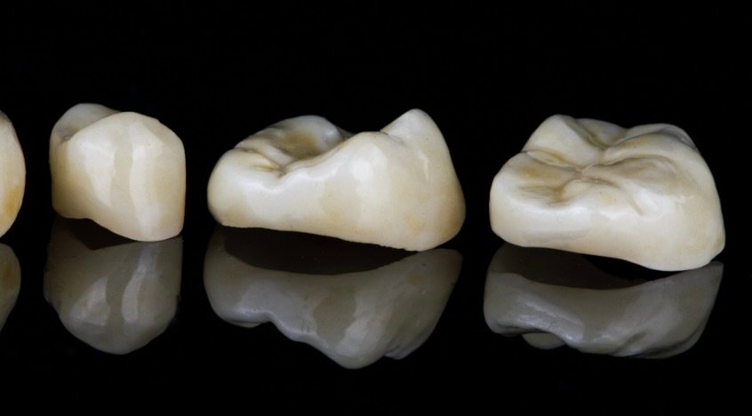 Differences Between Dental Crowns, Inlays, and Onlays: Solutions for ...